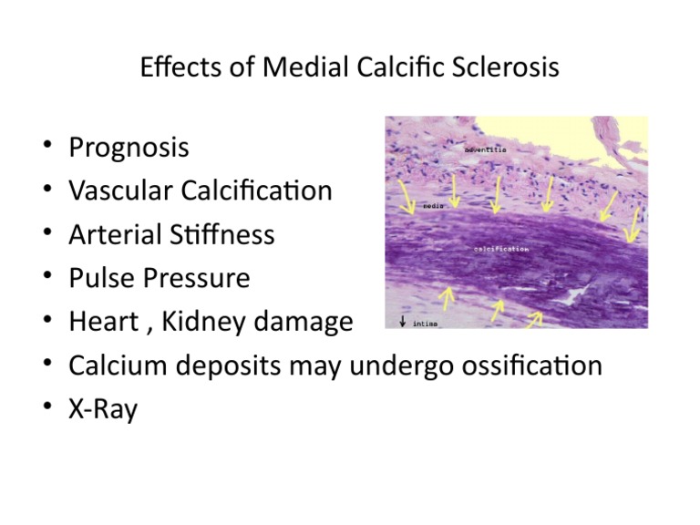 Effects of Medial Calcific Sclerosis | PDF
