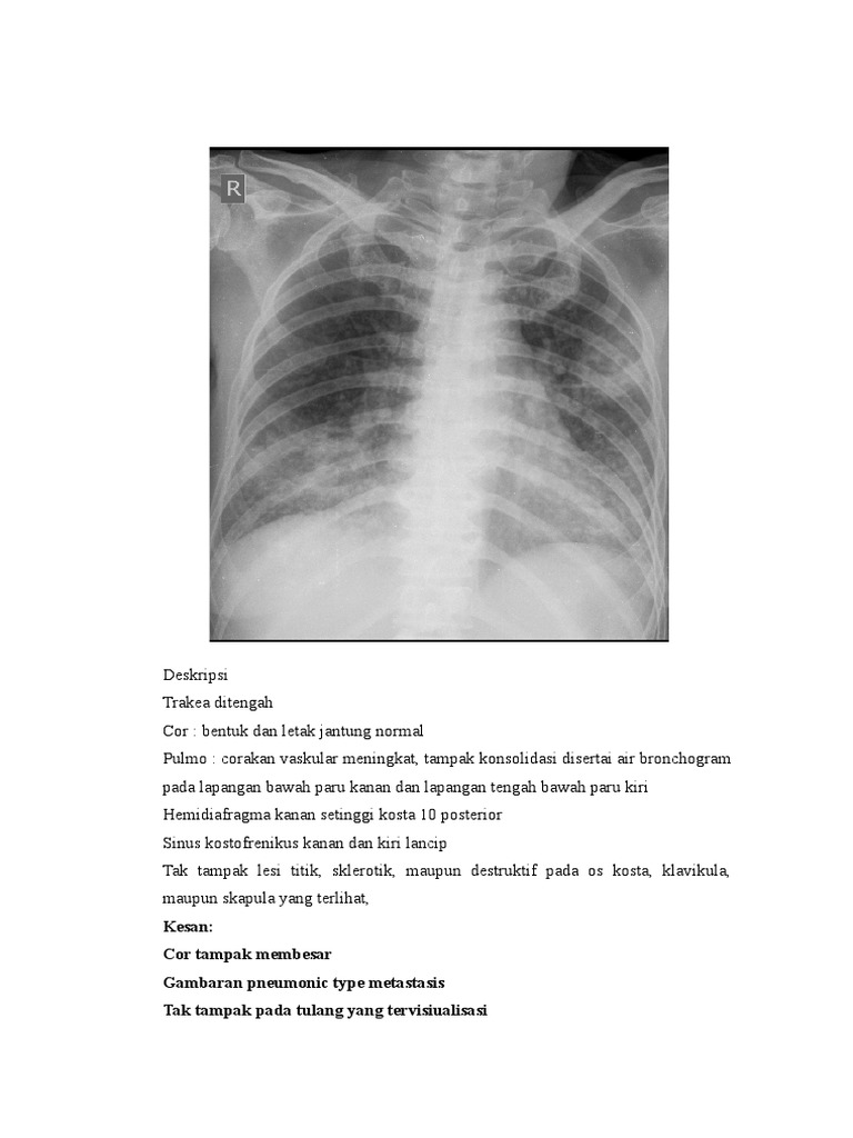 Gambaran Radiologi Paru dan Jantung | PDF | Seni