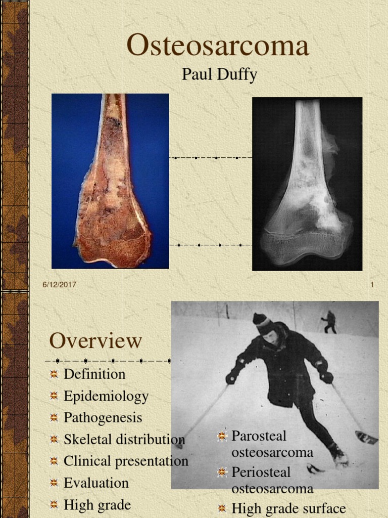 Osteosarcoma | Chemotherapy | Metastasis