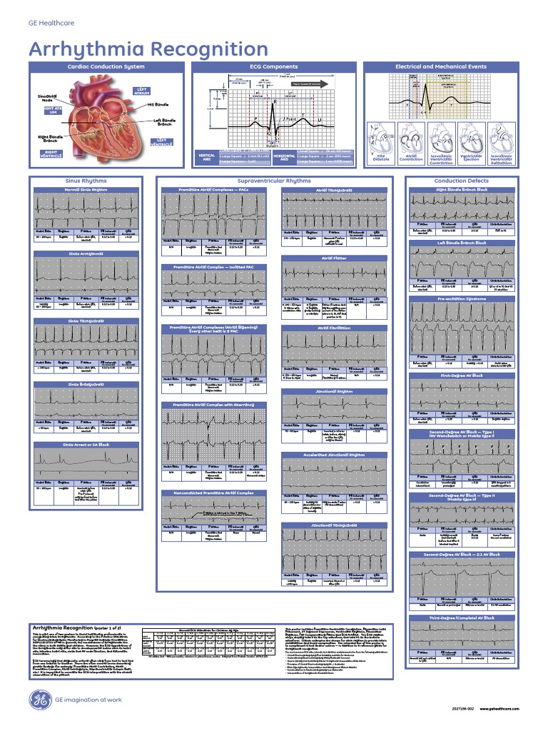 Poster1 Arrhythmia Recognition e PDF | PDF | Electrocardiography | Cardiac Arrhythmia