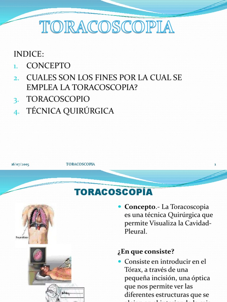 TORACOSCOPÍA