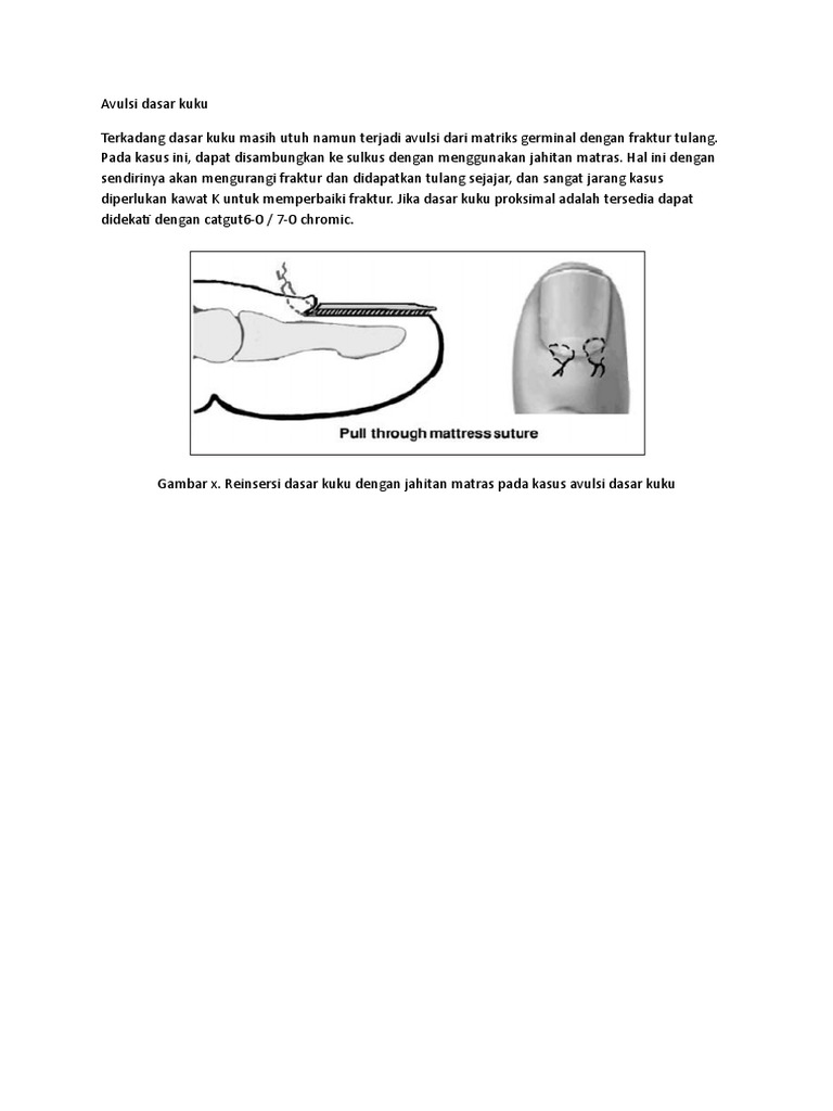 Avulsi Dasar Kuku | PDF