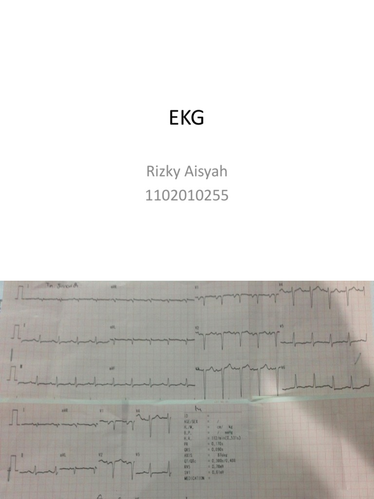 My Ekg | PDF