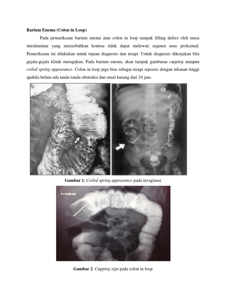 Colon in Loop, USG | PDF