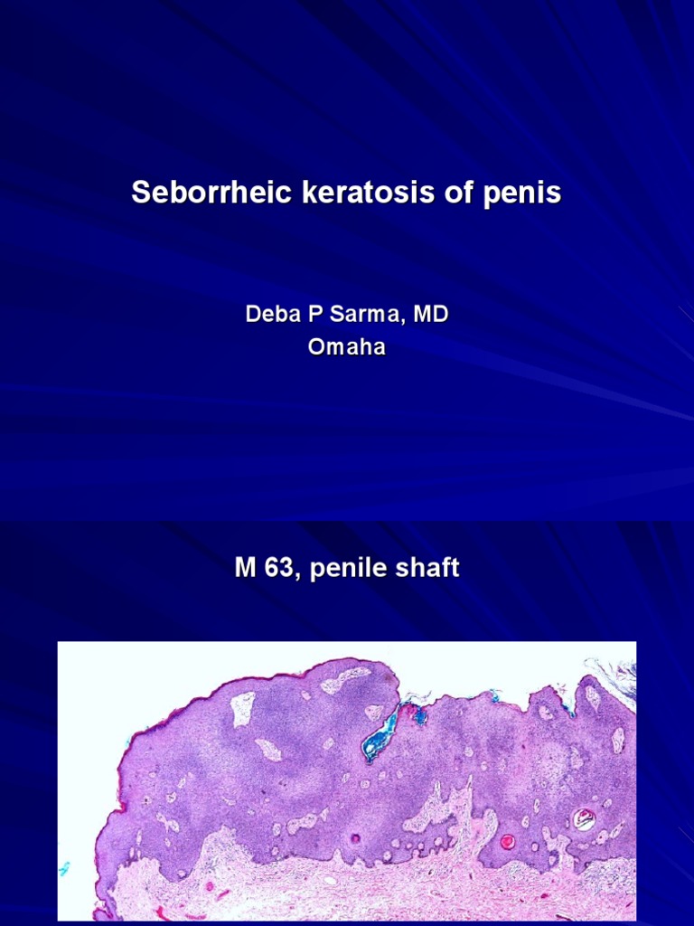 Seborrheic Keratosis of Penis, M 63, Penile Shaft. | PDF