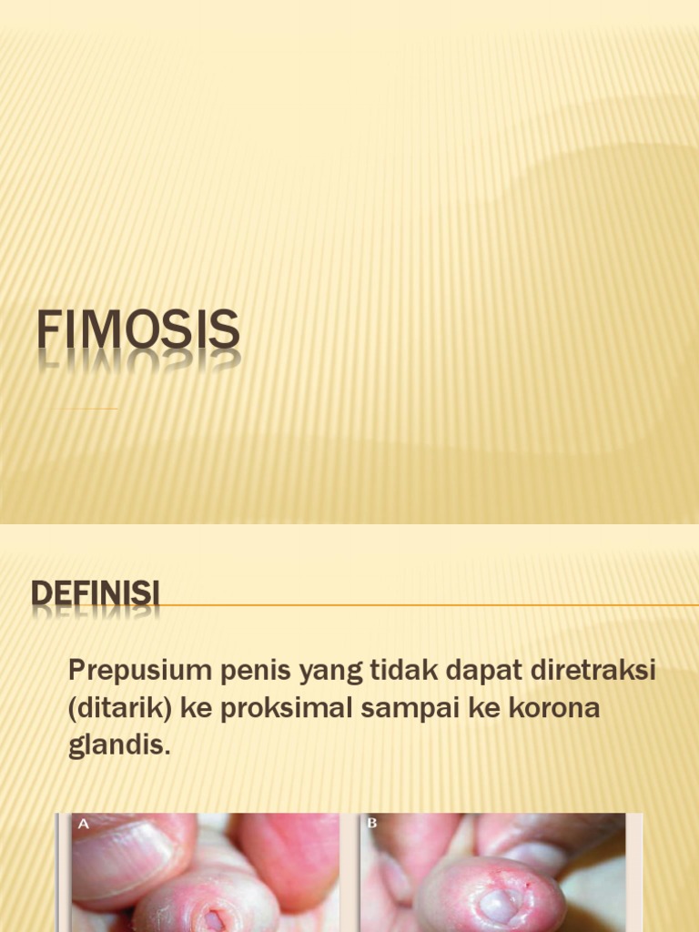 Fimosis Bedah Anak Edit | PDF