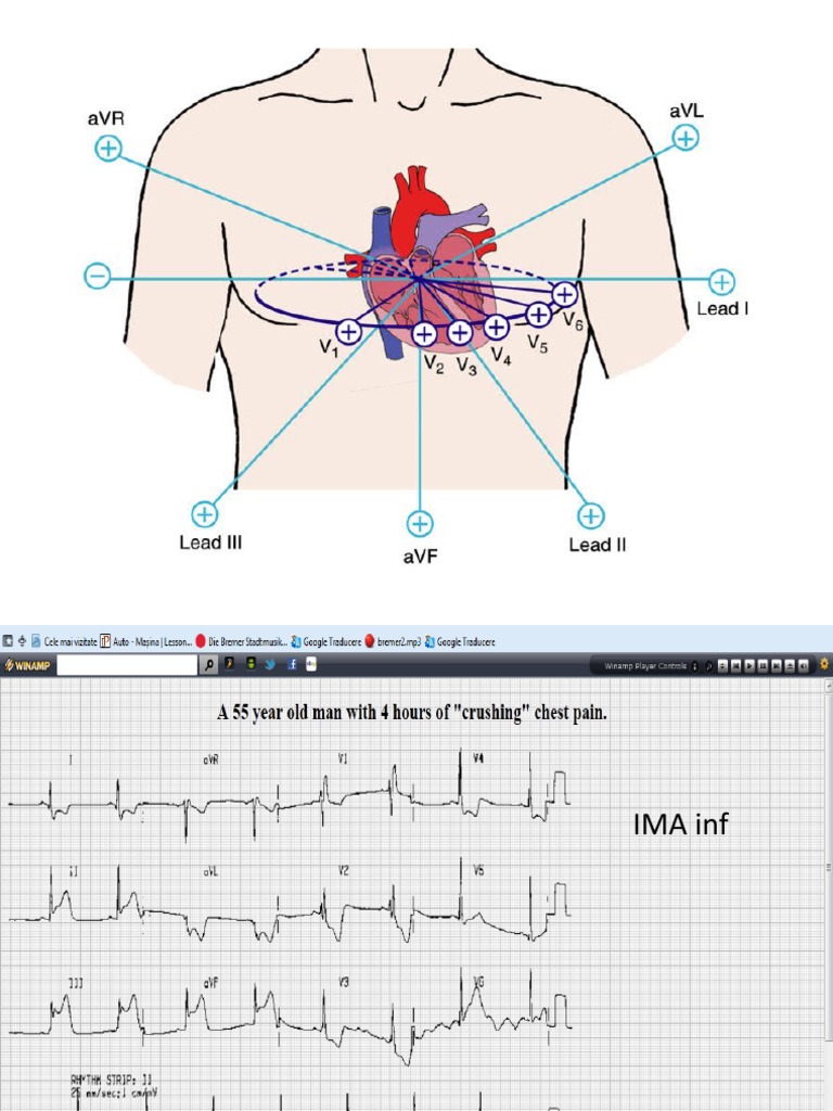 Exemple ECG | PDF