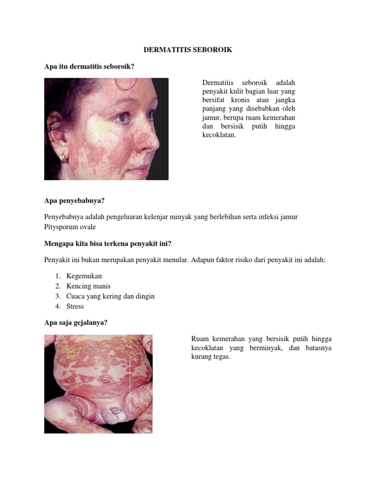 Pengertian dan Penanganan Dermatitis Seboroik | PDF