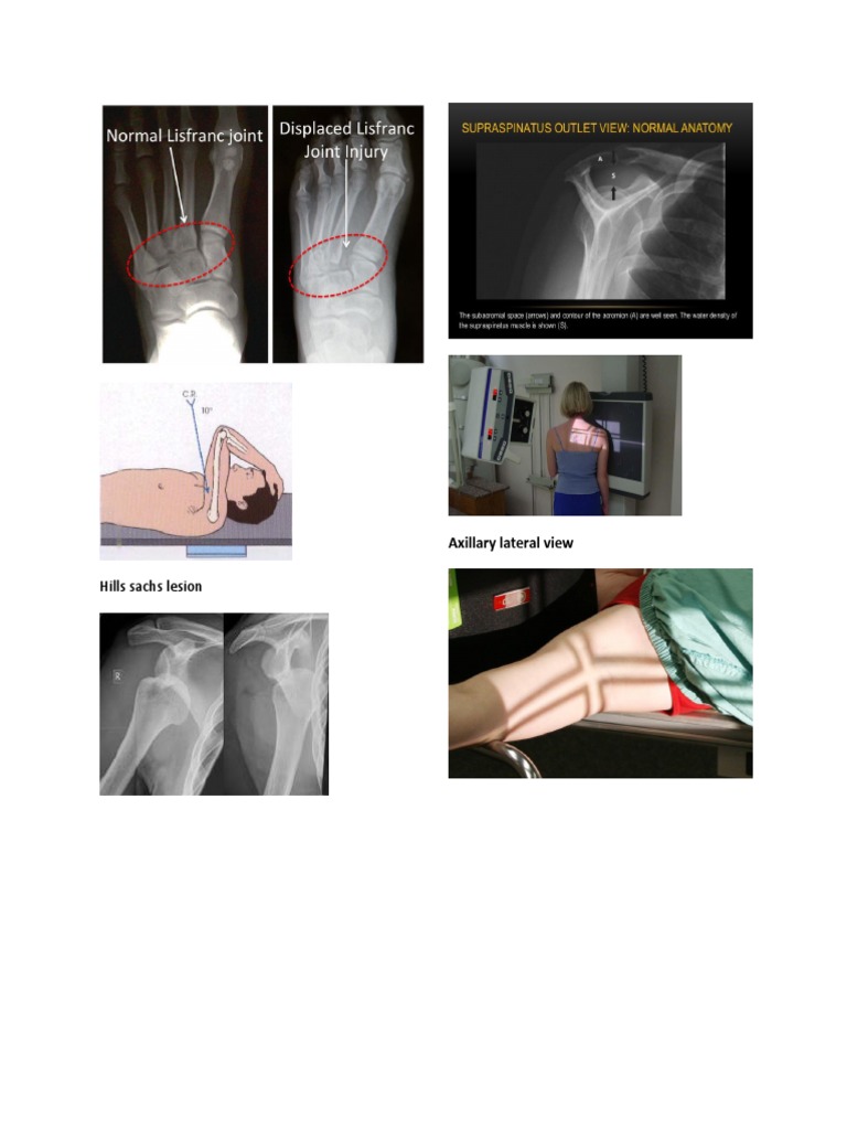 Hills Sachs Lesion: Axillary Lateral View | PDF