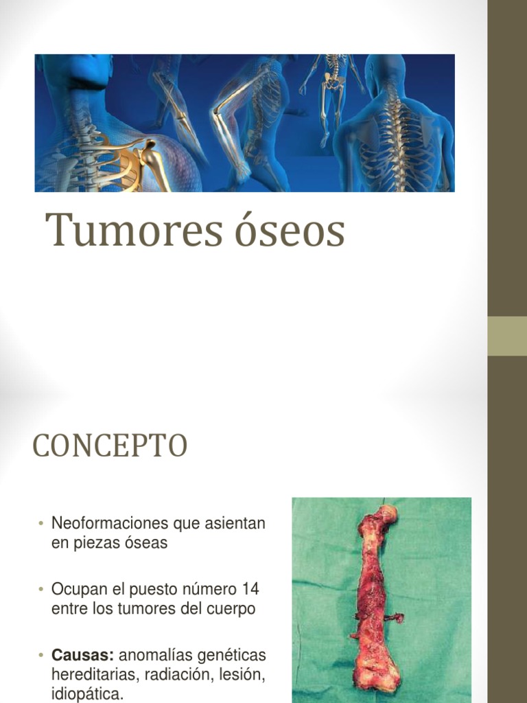 Tumores Oseos | PDF | Sarcoma | Cáncer