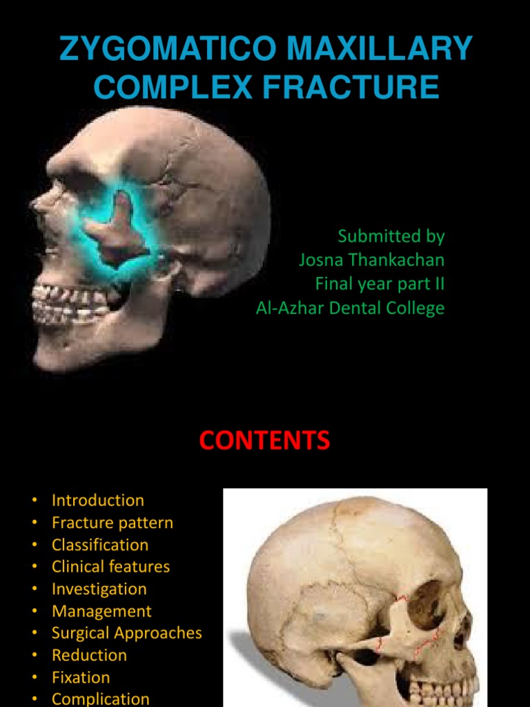 Zygomatic Maxillary Buttress