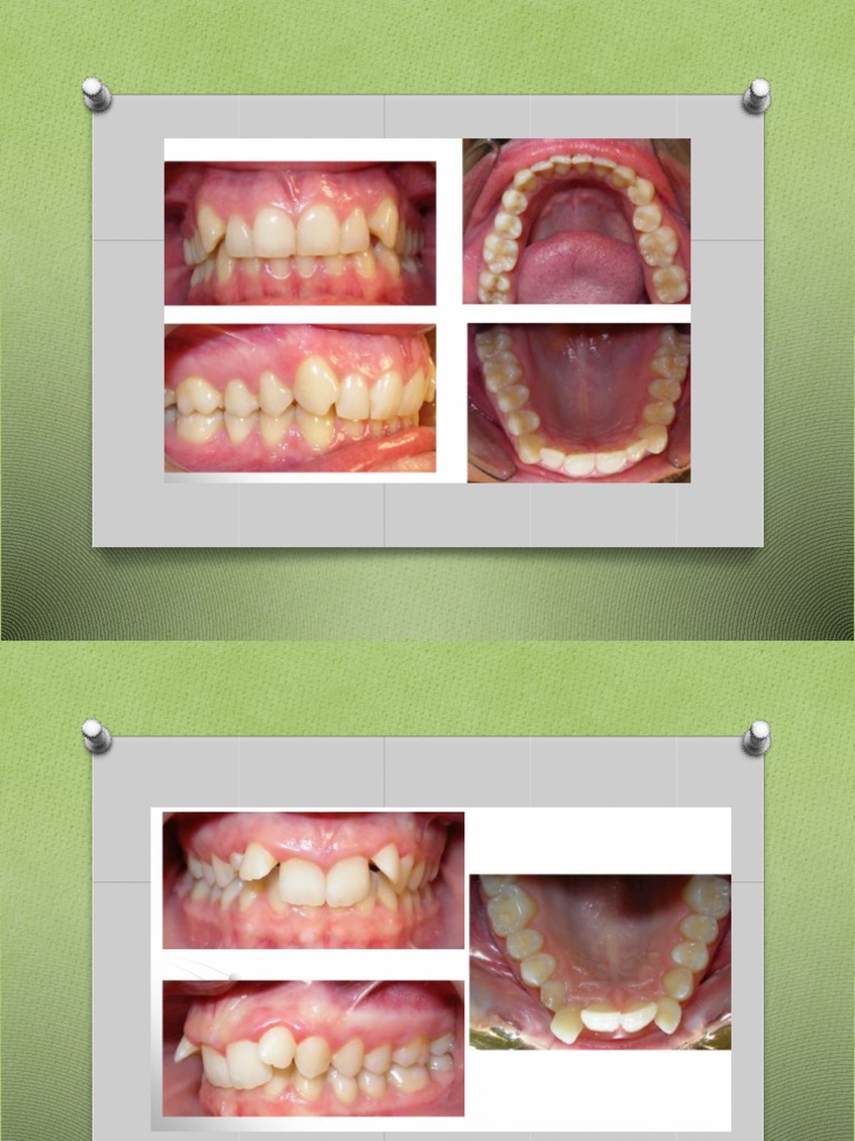 Crecimiento Del Complejo Nasomaxilar PDF | PDF | Cráneo | Hueso