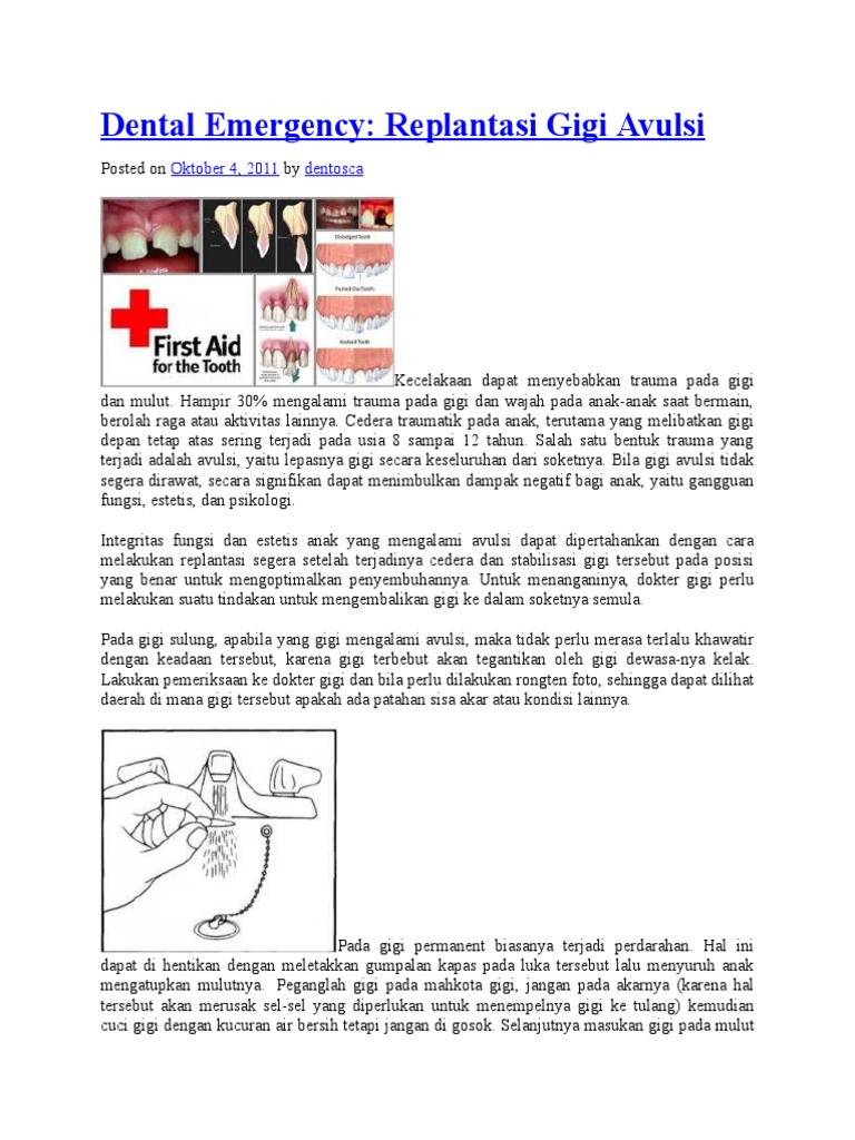 Penanganan Avulsi Gigi Anak | PDF