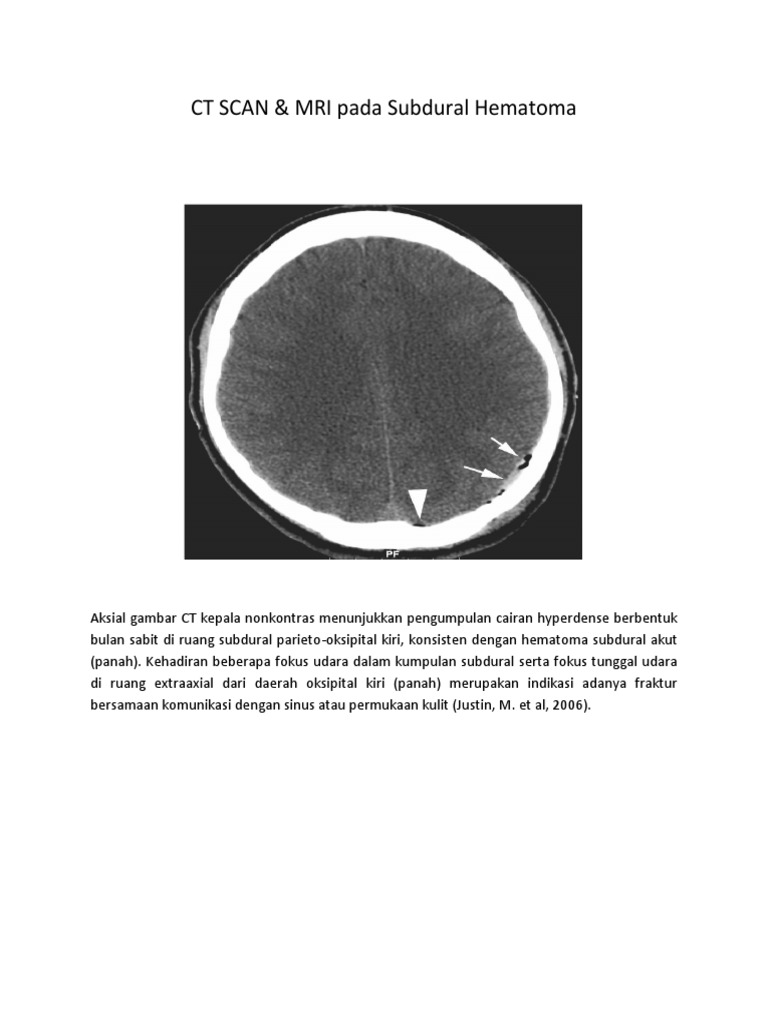 Gambaran CT-Scan Dan MRI SDH | PDF