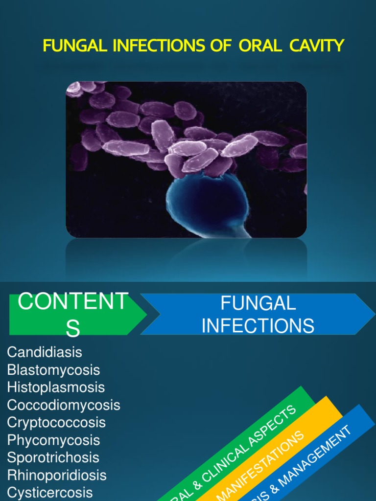 Fungal Infections of the oral cavity | Candidiasis | Medical Specialties