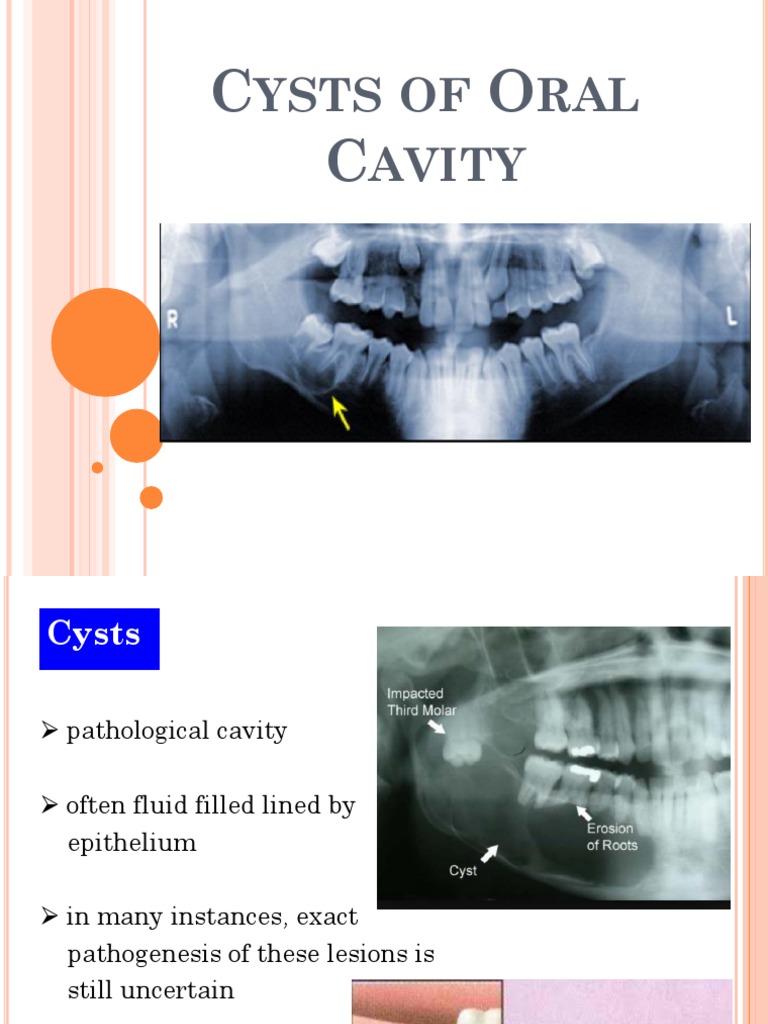 Cysts of the Oral Cavity Overview | PDF | Dentistry | Mouth