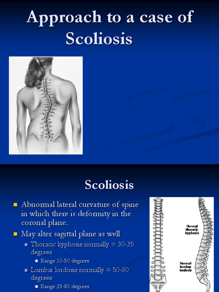 Approach To A Case of Scoliosis | PDF | Scoliosis | Vertebral Column