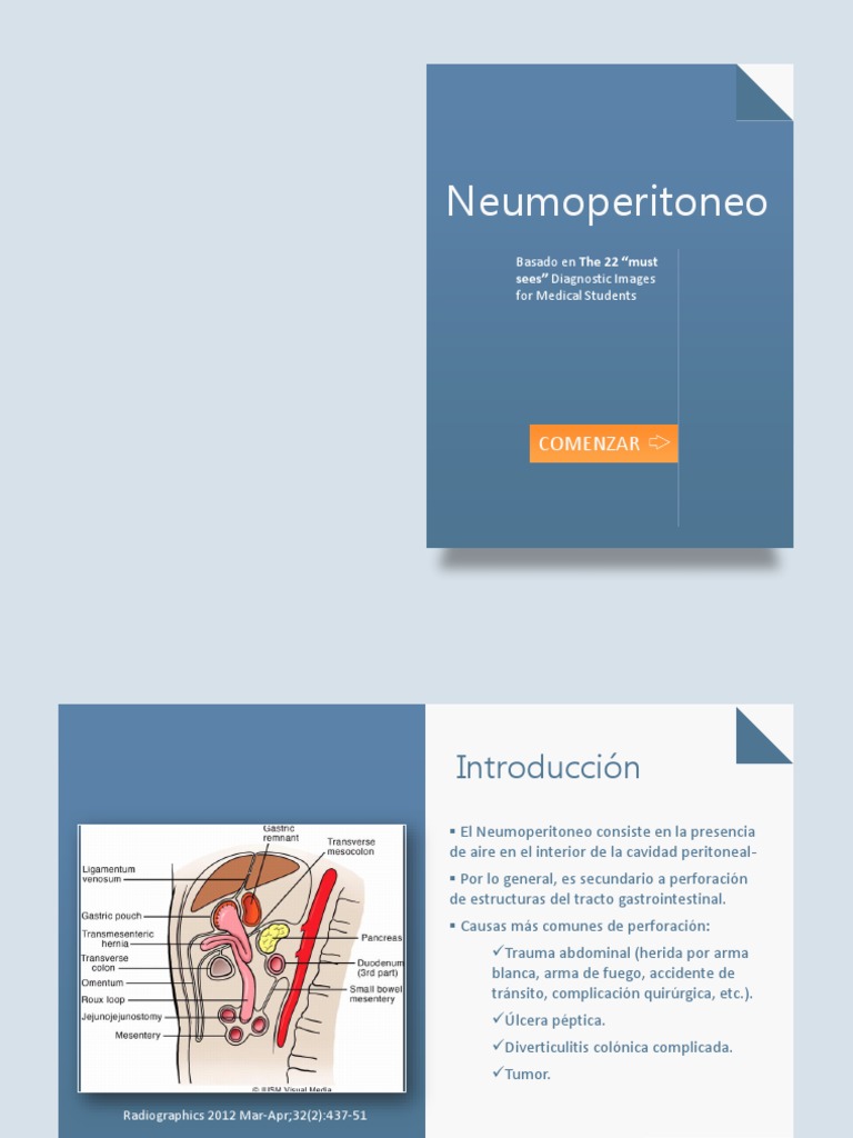 Representación visual del neumoperitoneo: identificando signos clave en ...