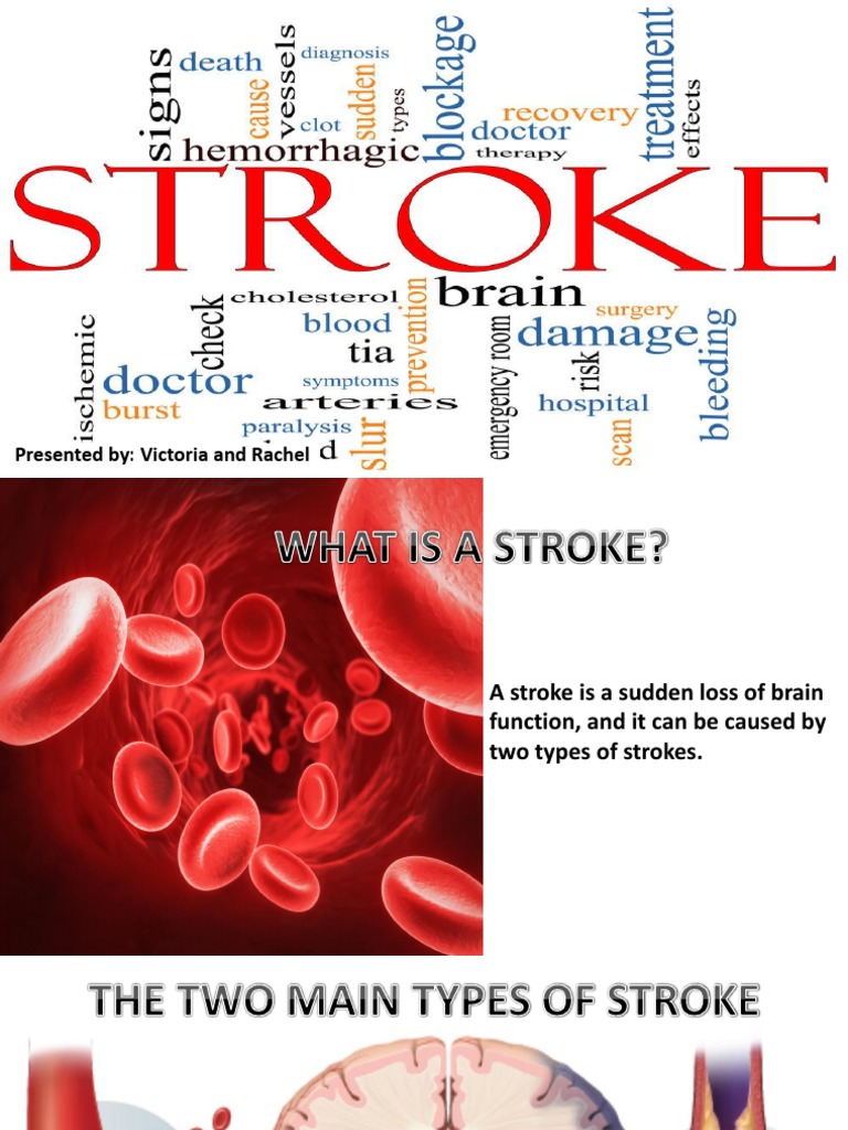 Stroke Presentation | PDF | Stroke | Ischemia