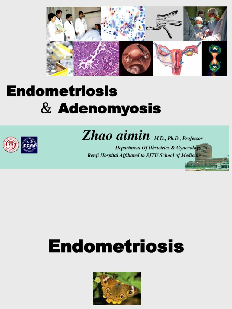 Endometriosis Adenomyosis Download Free Pdf Ovarian Cancer