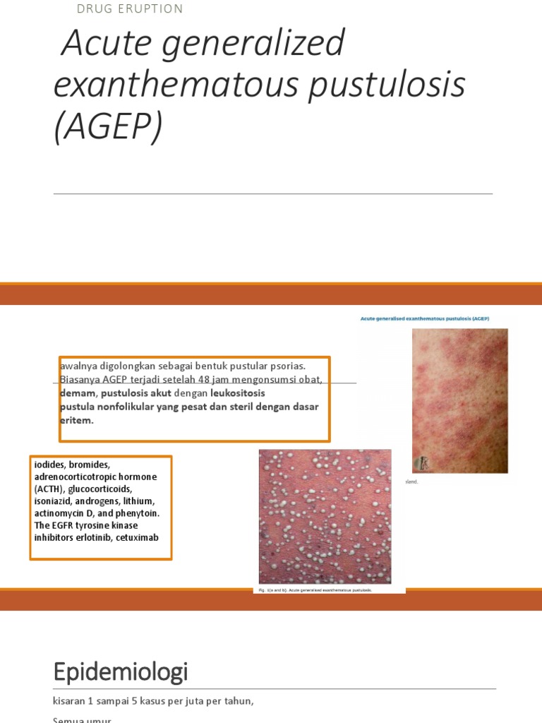 Acute Generalized Exanthematous Pustulosis (AGEP) - Stase Kulit | PDF