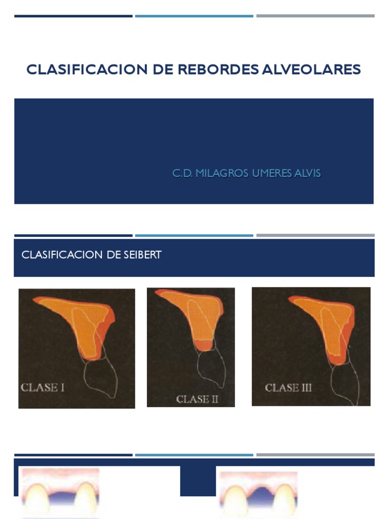 Clasificacion de Rebordes Alveolares.allen Seibert