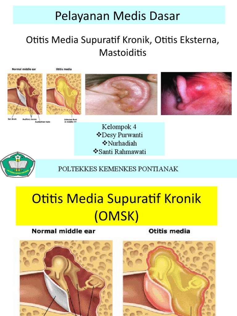Otitis Media Supuratif Kronik (OMSK) | PDF