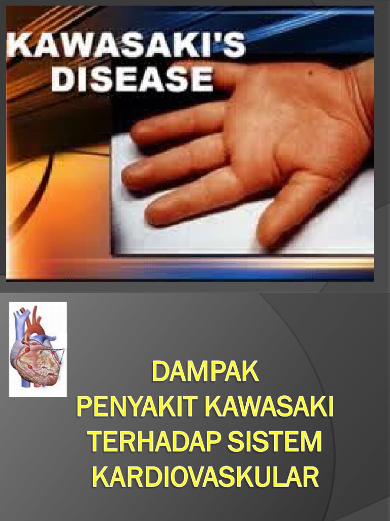 Penyakit Kawasaki Di Indonesia Prevalensi Yang Lebih Tinggi Dari Yang