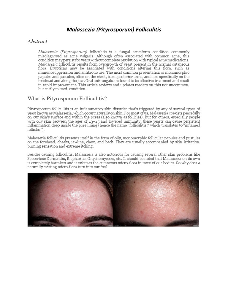 Pityrosporum Folliculitis | Immune System | Immunology