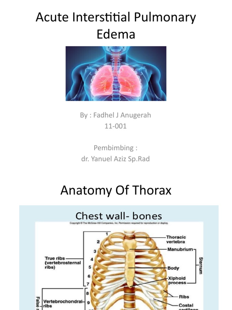 Acute Interstitial Pulmonary Edema Power Point Fix | PDF | Edema ...