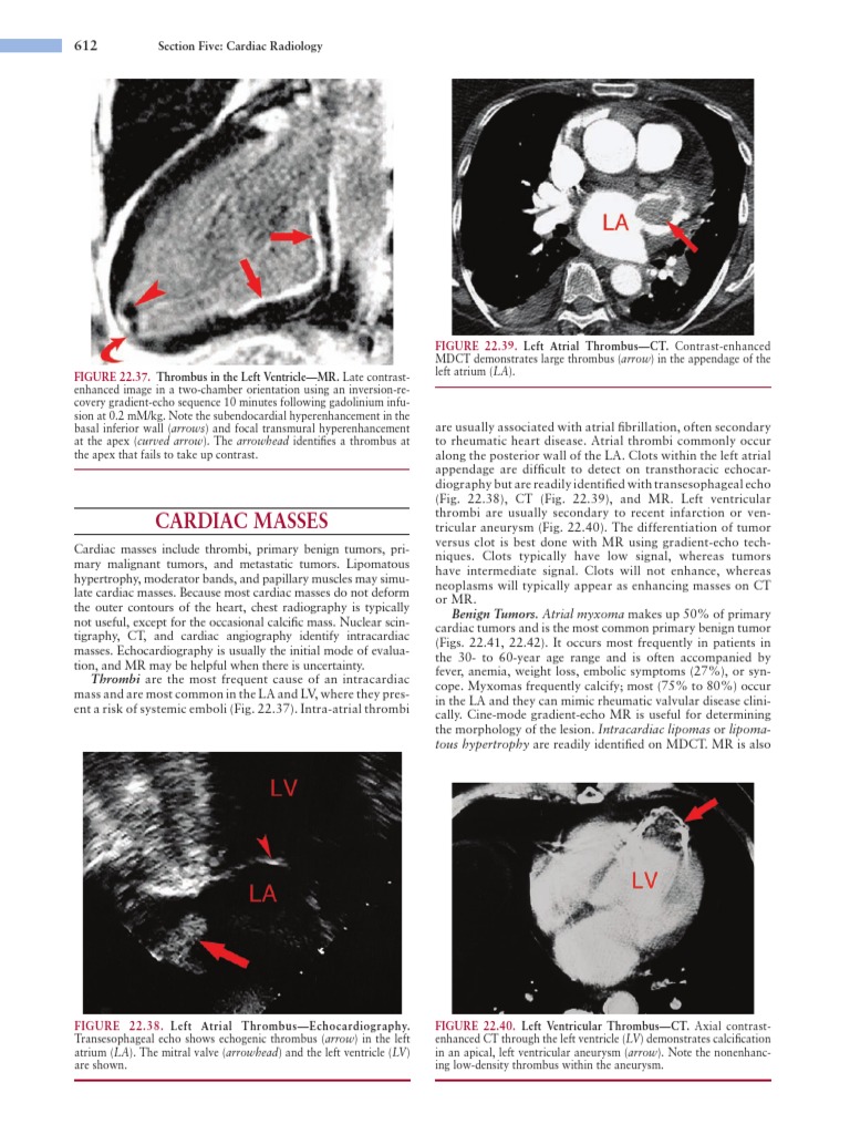 Fundamentals of Diagnostic Radiology Cardiac Masses | PDF | Atrium ...