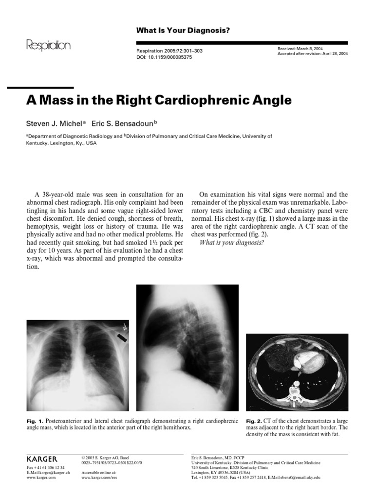 A Mass in The Right Cardiophrenic Angle: Steven J. Michel Eric S ...
