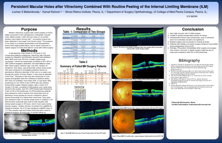 Persistent Mac Hole Combined w Routine Peeling of Ilm | Ophthalmology ...