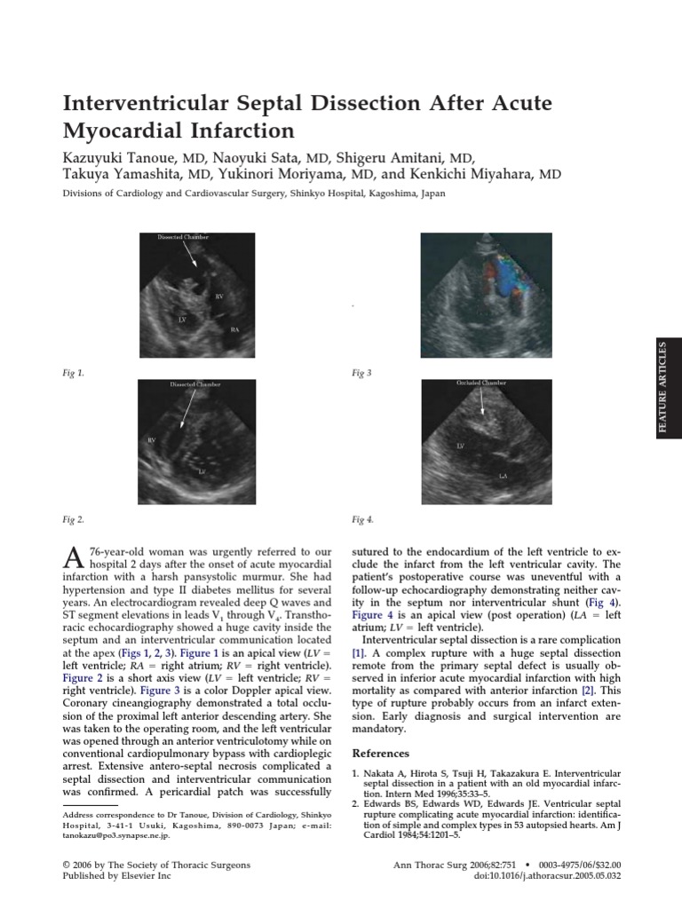 Images - Interventricular Septal Dissection After Acute Myocardial ...