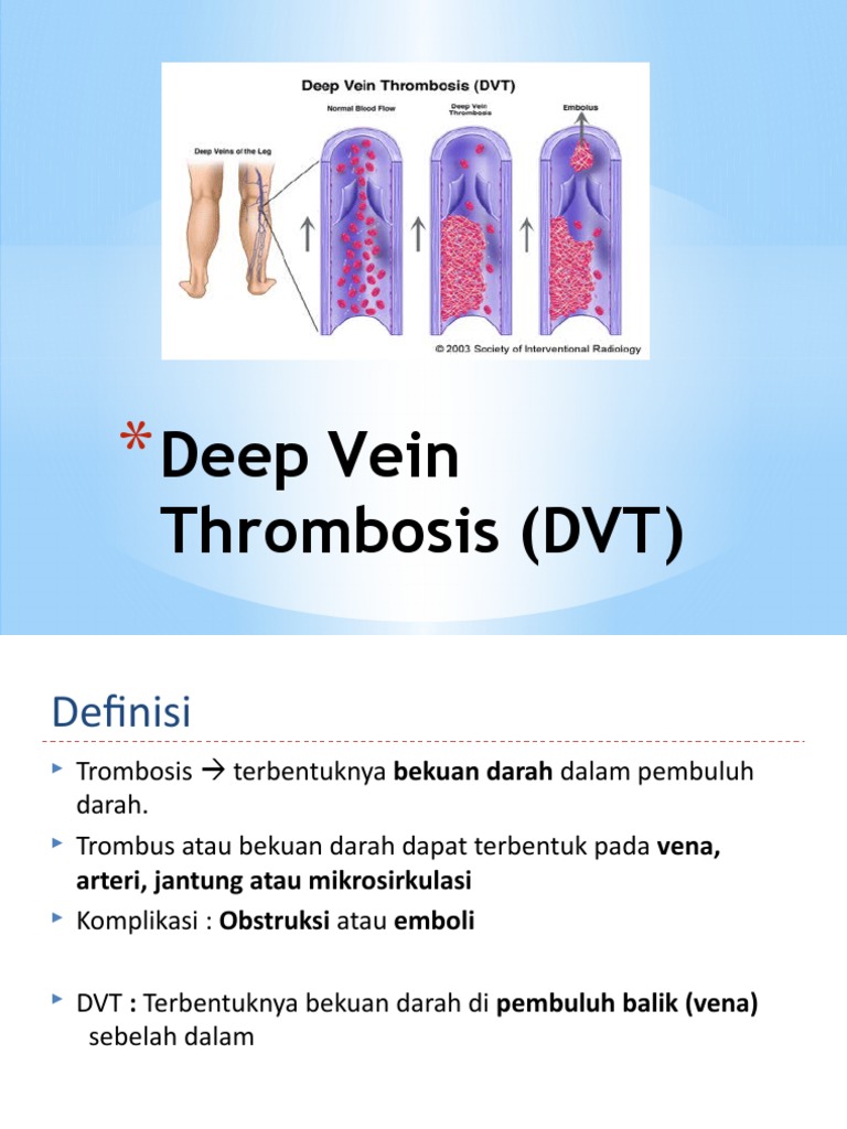 Deep Vein Thrombosis (DVT) | PDF