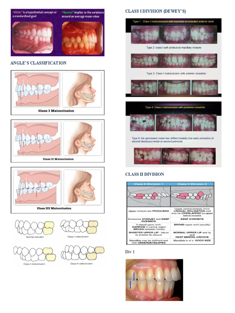 Dewey's Class I Orthodontic Overview | PDF | Foreign Language Studies