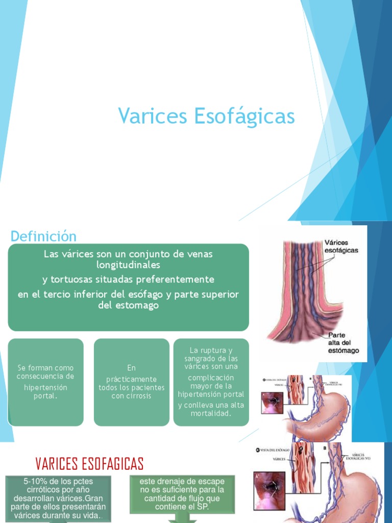 Varices Esofágicas | PDF | Especialidades Medicas | Medicina CLINICA