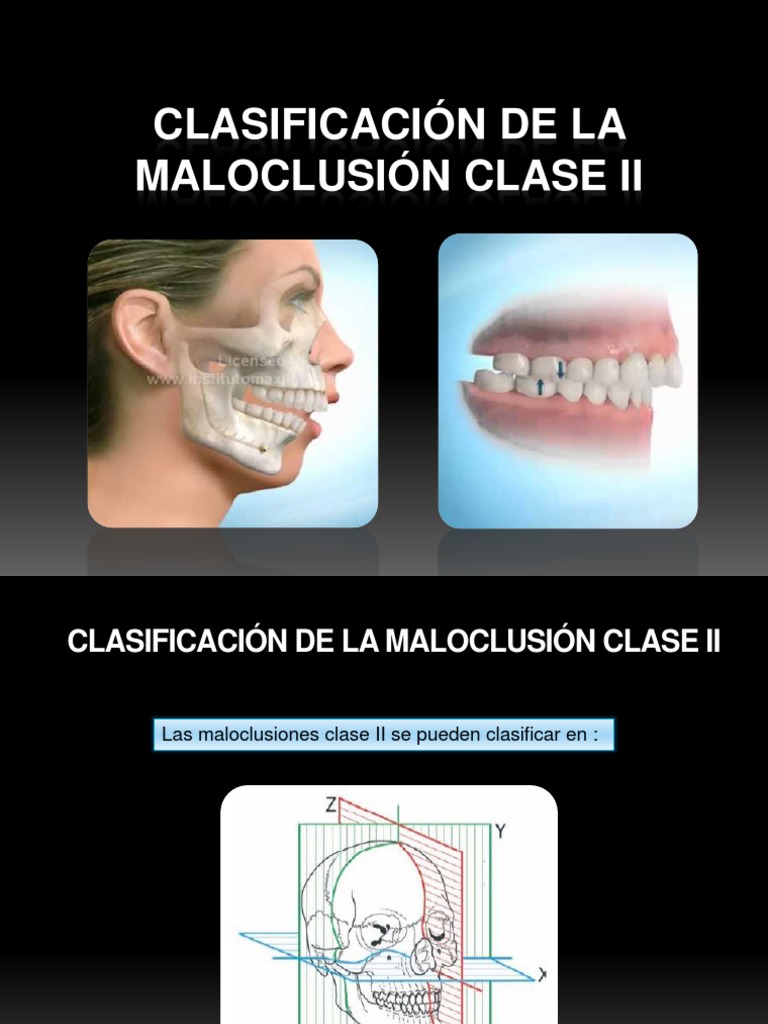 Clasificación de Maloclusión Clase II | PDF | Anatomia dental | Boca