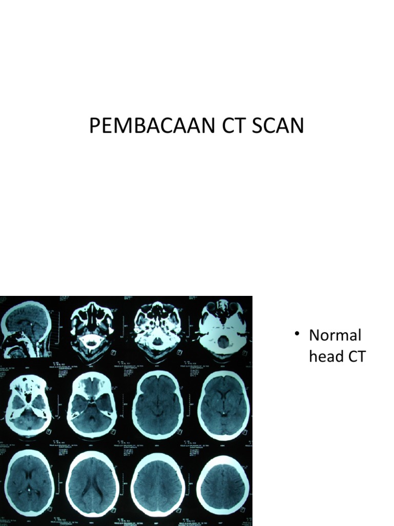 Pembacaan CT Scan | PDF