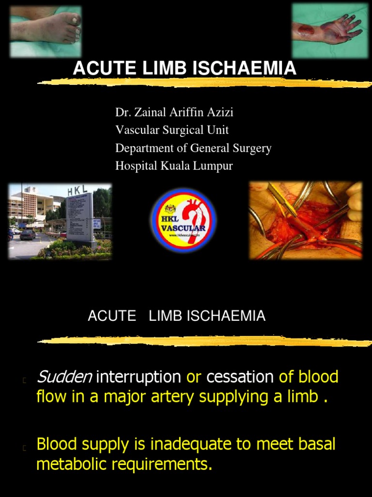 Acute Limb Ischaemia | PDF | Ischemia | Thrombosis