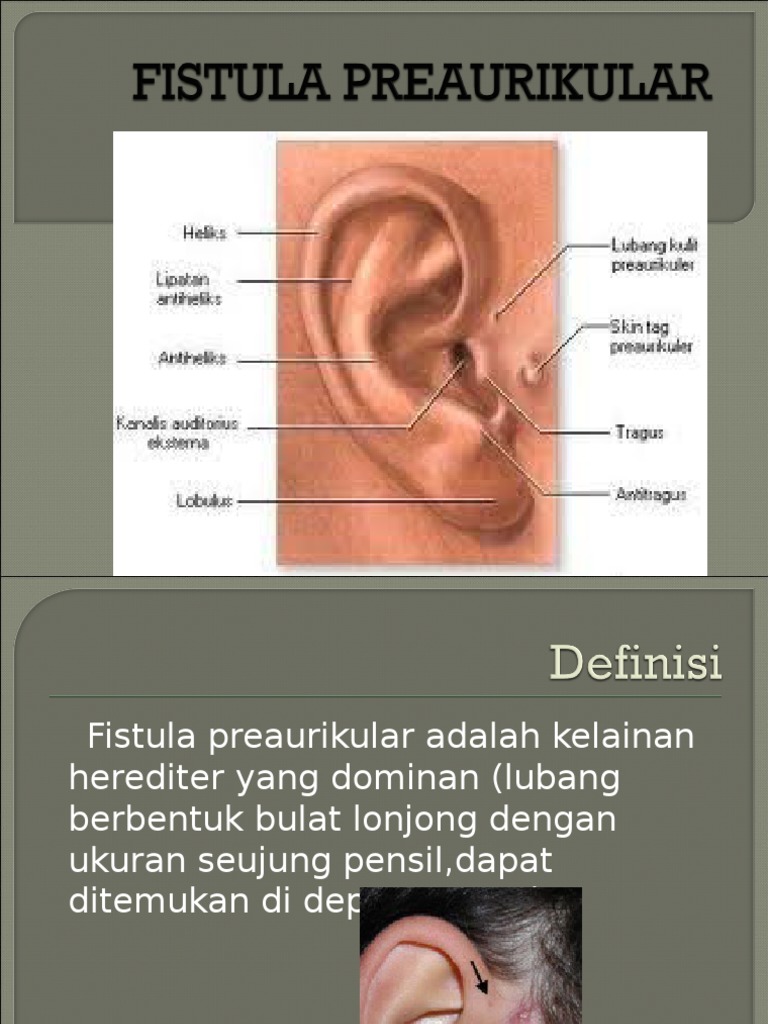 Fistula Preaurikular | PDF