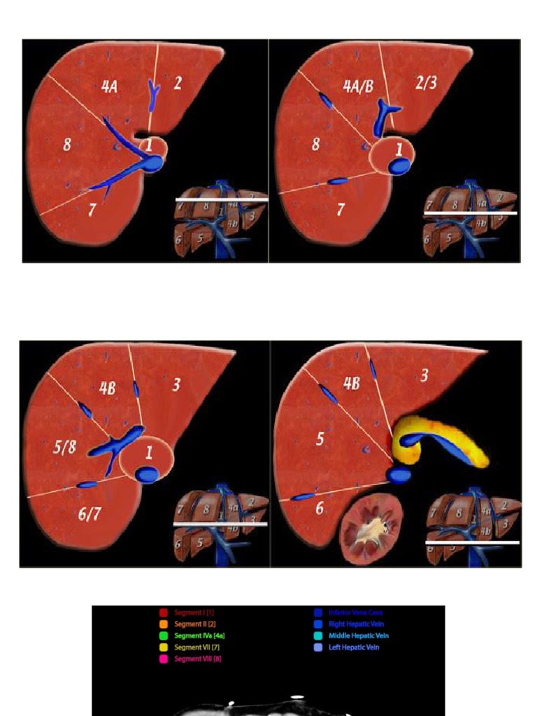 Segmentación Hepática PDF | PDF