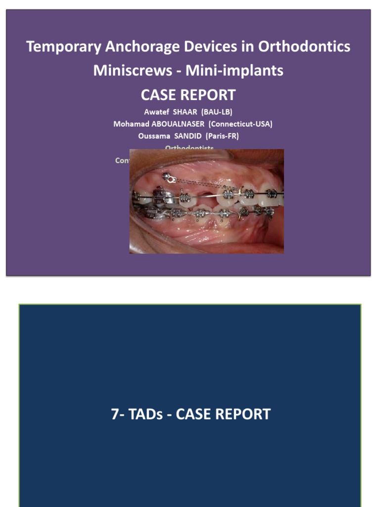 6-Mini-Implant-Miniscrews in Orthodontics-Case Report-Oussama Sandid ...