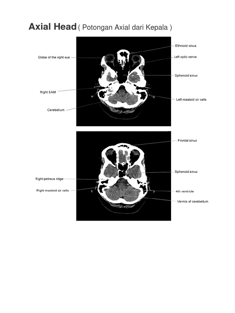 Potongan Axial CT Scan Kepala | PDF