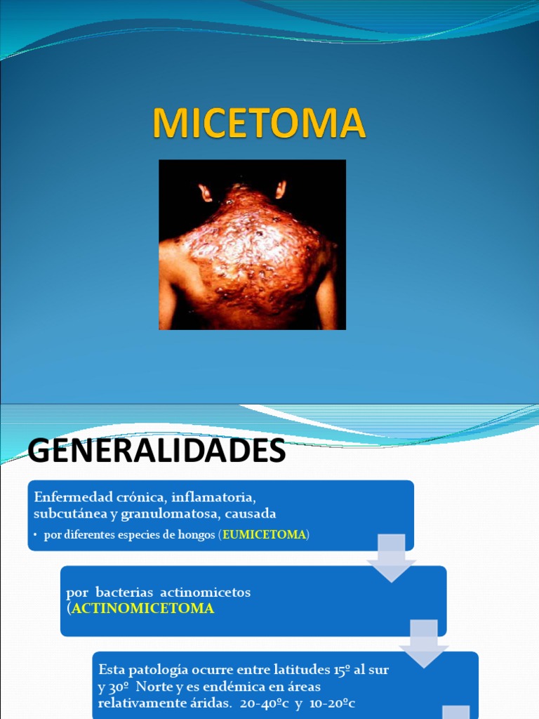micetoma-1-1-1.ppt (1) | Salud pública | Especialidades Medicas