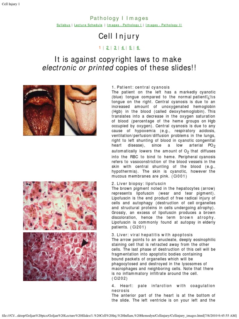 Review Goljan Pictures With Notes PDF | PDF | Hypercholesterolemia ...