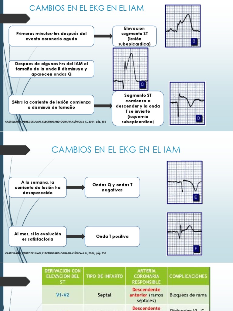 CAMBIOS EN EL EKG EN EL IAM.pptx | Electrocardiografia | Electrofisiologia