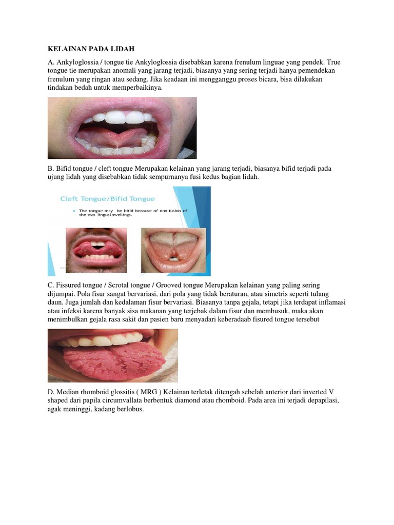 Kelainan Pada Lidah | PDF