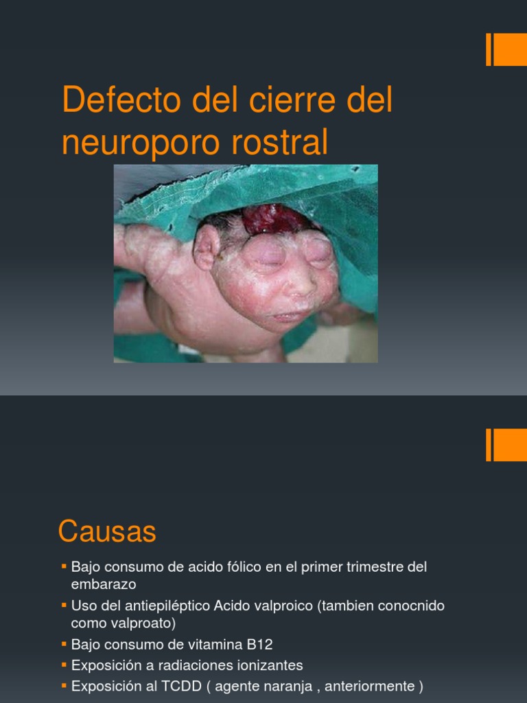 Defectos Del Cierre Del Neuroporo Rostral | PDF