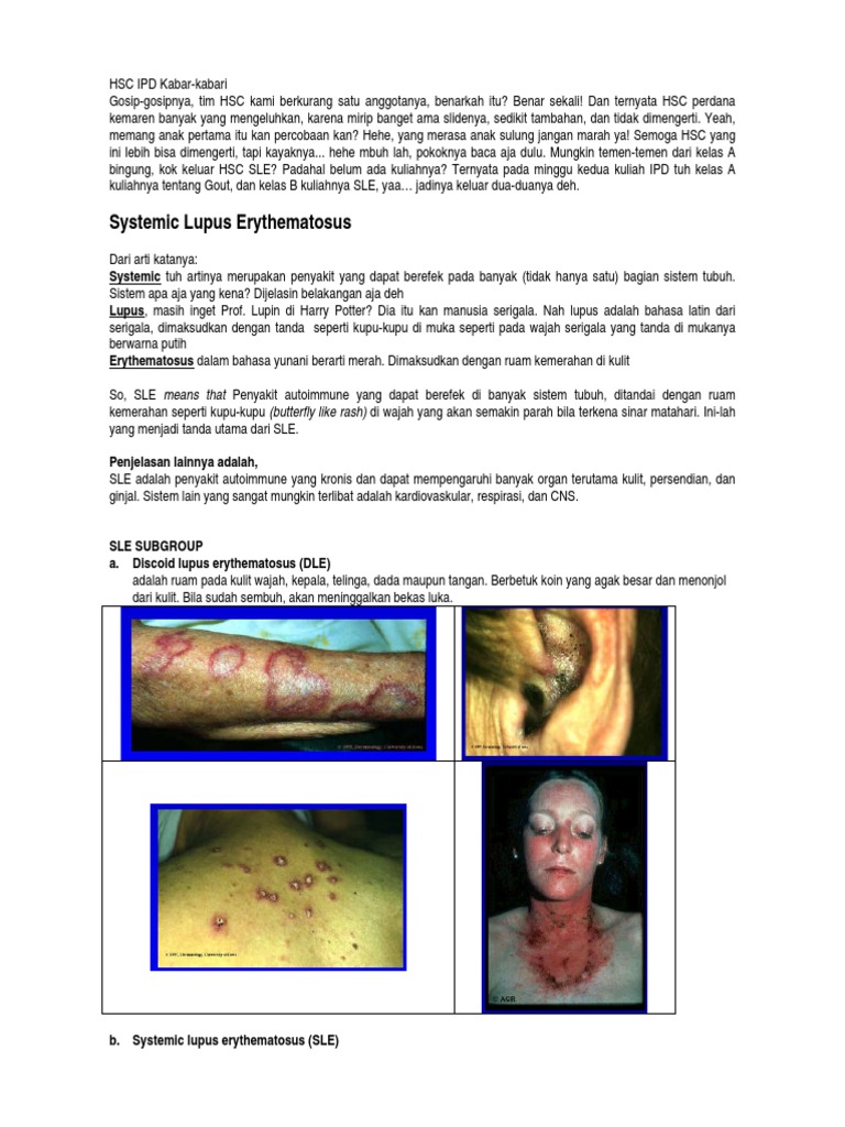 Systemic Lupus Erythematosus PDF | PDF